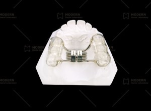 Quad-Helix Appliance – Modern Dental Lab