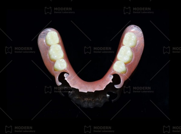 Resure Partial Denture – Modern Dental Lab