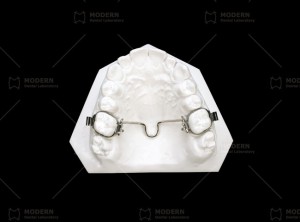 Nance Appliance – Modern Dental Lab