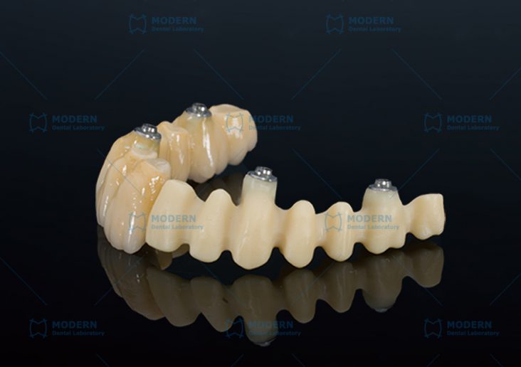 Digitek Zirconia Implant Bridge (with Ti-base) | Modern Dental Lab